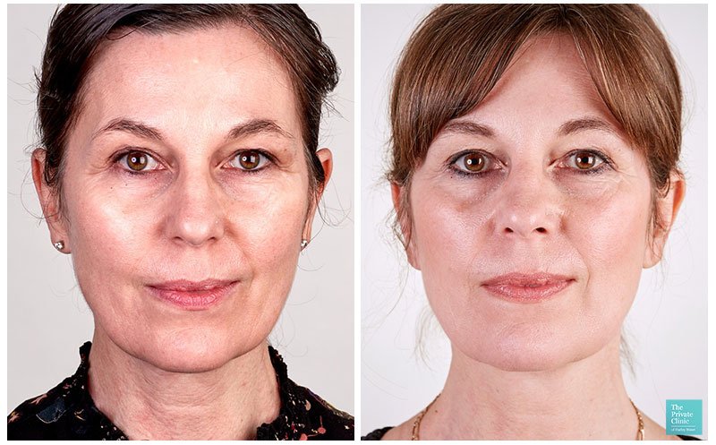 10 Secrets to Achieving a Full Face Lift Without Surgery